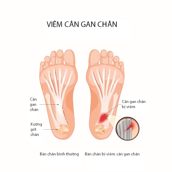 Viêm cân gan bàn chân: Định nghĩa, dấu hiệu và điều trị | ACC